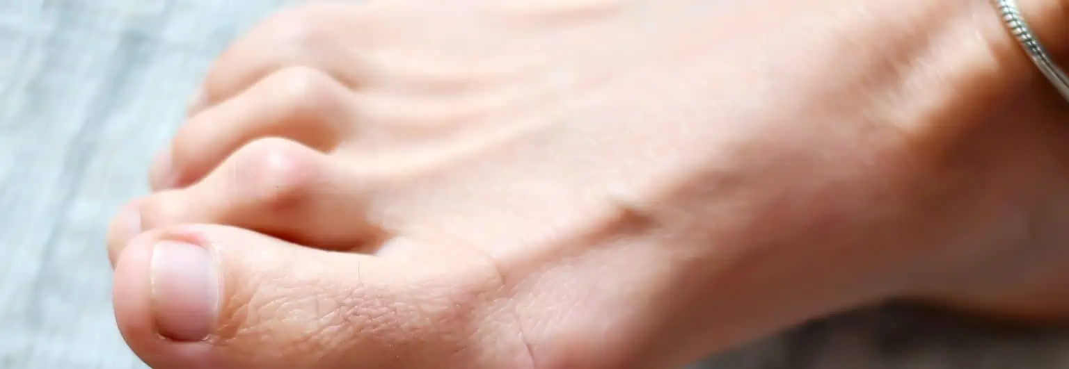 Hamerteen en het nut van corrigerende zooltjes