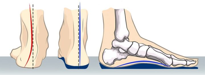 Voetklachten of pijnlijke voeten? Zoek de oorzaak en los op!
